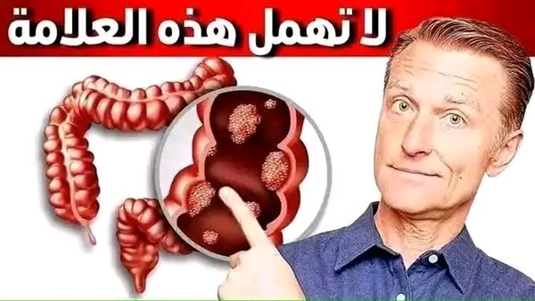 سړطان القولون لا تظهر عادة أعراضه في المراحل المبكرة هناك علامة قد ...